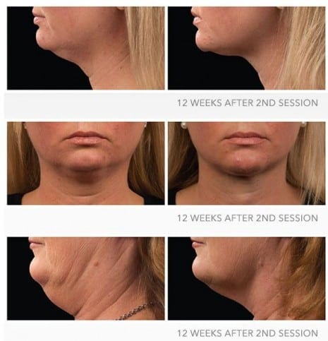 Cool Mini™ for Double Chins - Skin Envy