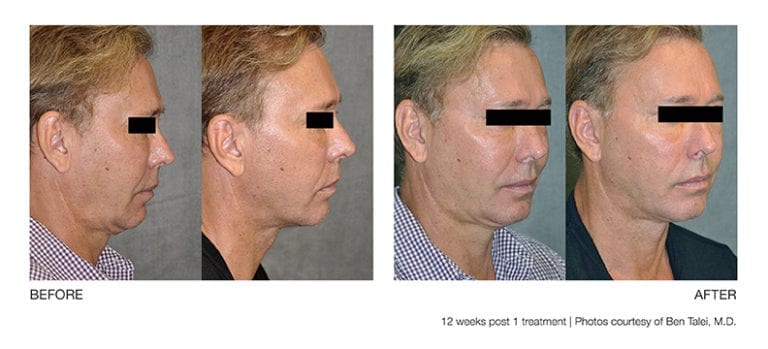 Profound Lift Radio Frequency Skin Tightening - Austin, TX